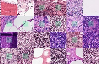 Tumor Detection in Lymph nodes | Academic